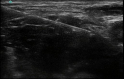 Figure 3. Needle placed into the wedge-shaped tissue space lateral to ...