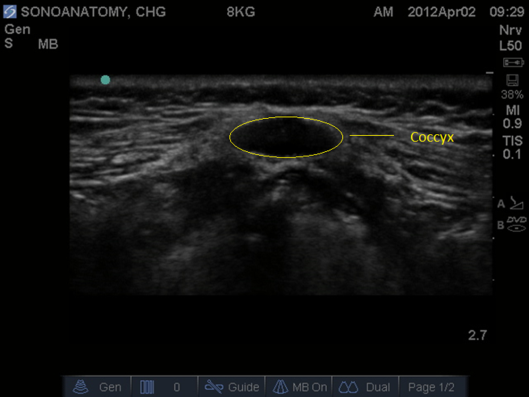 Fig 3. Ultrasound Probe in Midline Transverse position moved cephalad ...