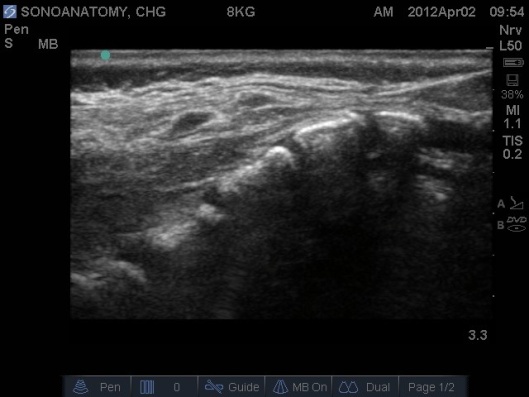 Caudal Anesthesia Technique
