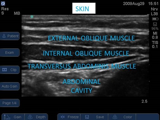 Place the ultrasound probe in a transverse plane between the iliac ...