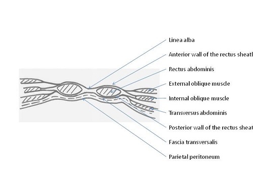 Arcuate Line Of Rectus Sheath