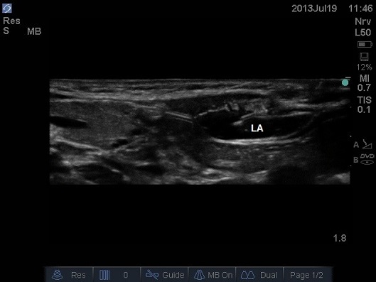 ULTRASOUND OF NEONATAL ABDOMEN IN THRANSVERSE PLANE. THE LOCAL ...