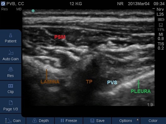 Fig 8. Transverse Plane Mid-Thoracic level. PSM – paraspinal muscles ...