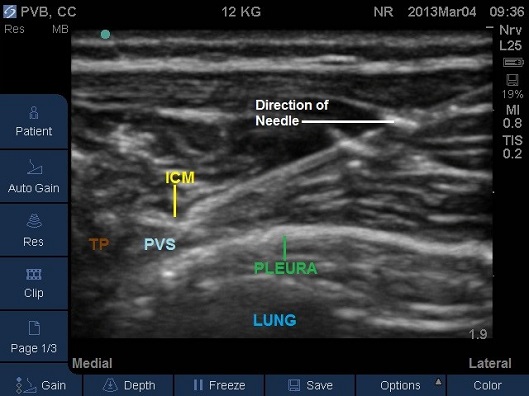 Fig 12. Transverse Plane Mid-Thoracic level showing in plane technique ...