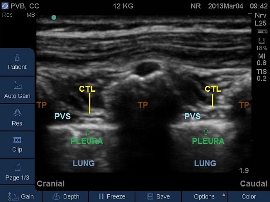 Fig 18. Parasagittal plane at mid-thoracic level. CTL – costotransverse ...